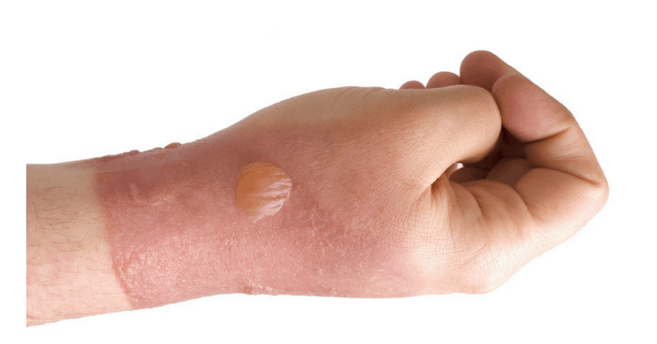 5 Mitos Penanganan Luka Bakar yang Harus Dihindari | Good Doctor | Tips ...